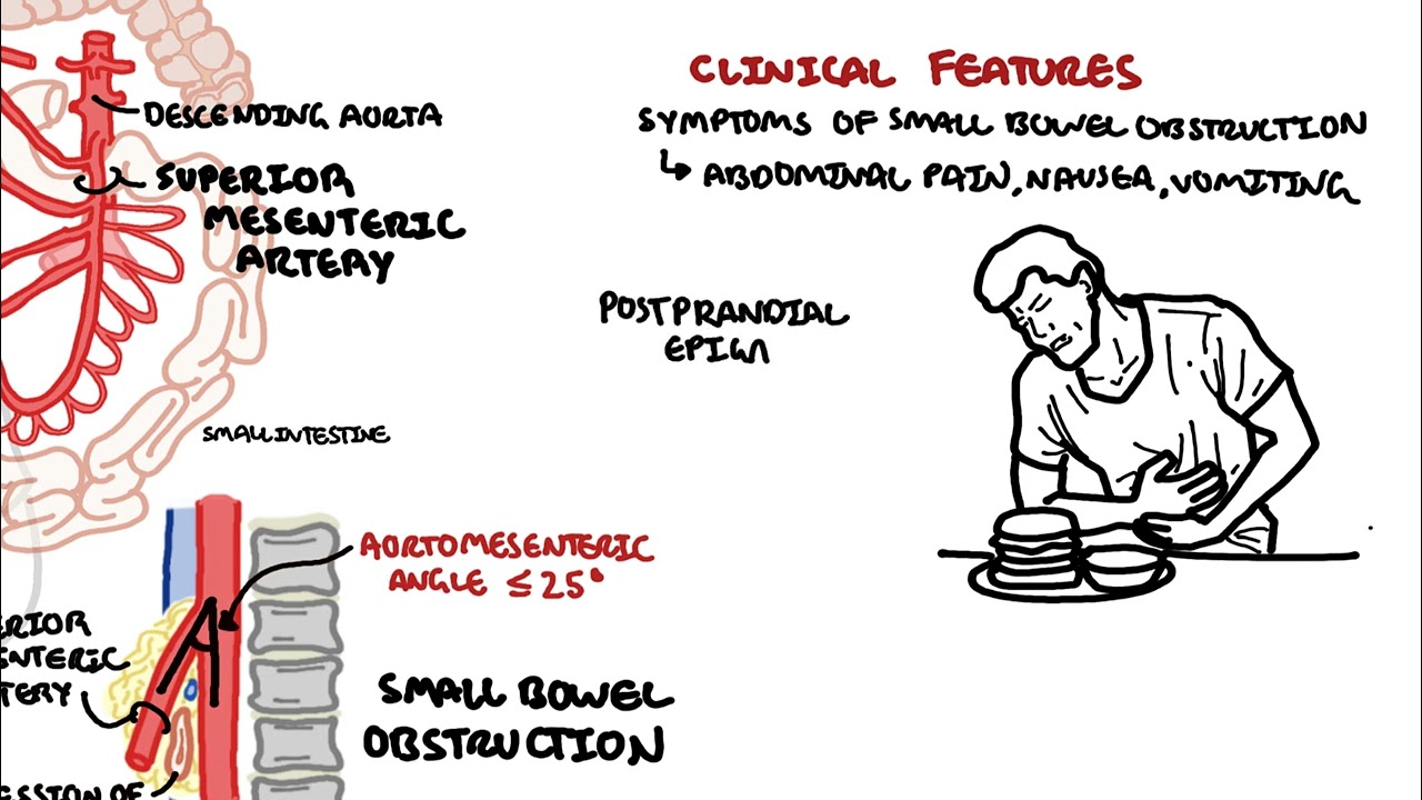 Superior mesenteric artery syndrome (SMA Syndrome) and Nutcracker Syndrome