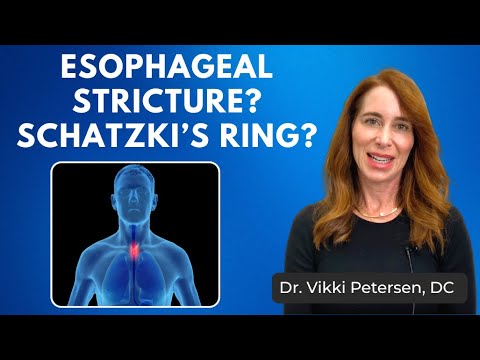 Esophageal Stricture? Schatzki’s Ring? Here’s what to do!