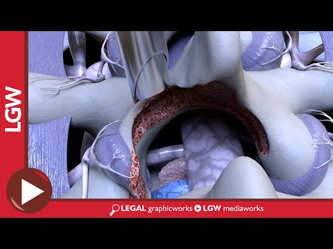 Lumbar Laminoforaminotomy and Partial Discectomy 3D Animation