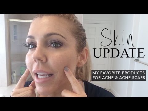 Skin Update: favorite products for acne and acne scars