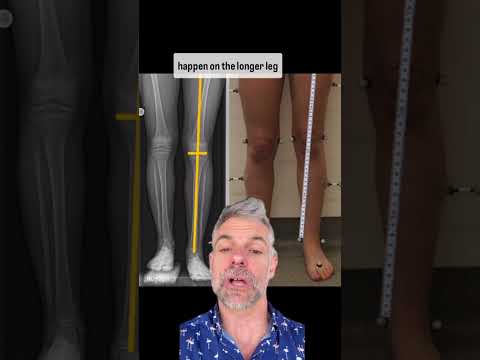 Unchecked or untreated leg length discrepancy may influence and or cause back pain in the future.