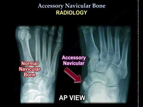 Hueso navicular accesorio: todo lo que necesita saber - Dr. Nabil Ebraheim