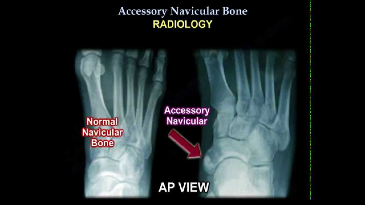 Accessory Navicular Bone - Everything You Need To Know - Dr. Nabil Ebraheim