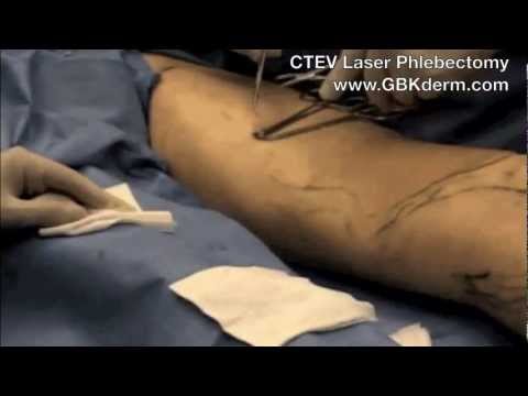 CTEV Laser Vein Removal | Laser Phlebectomy | San Diego