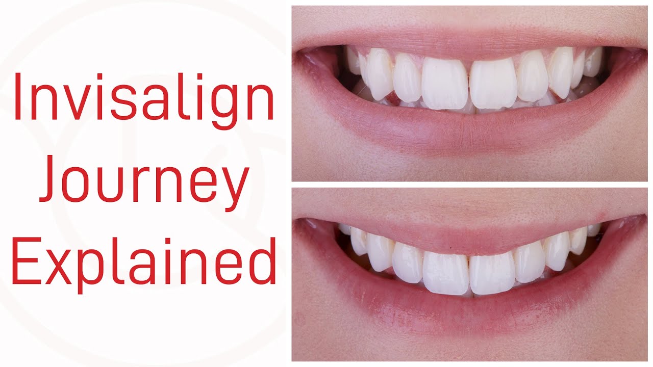 Invisalign Journey Explained
