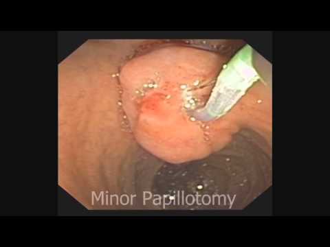 ERCP of Giant Santorinicele in Setting of Pancreas Divisum