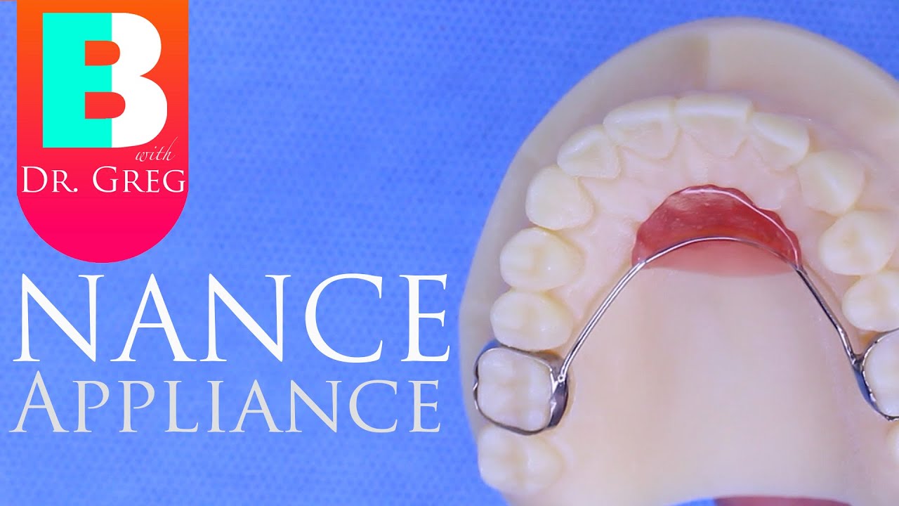 Nance Appliance during Braces