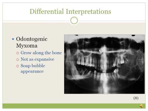 Ameloblastoma