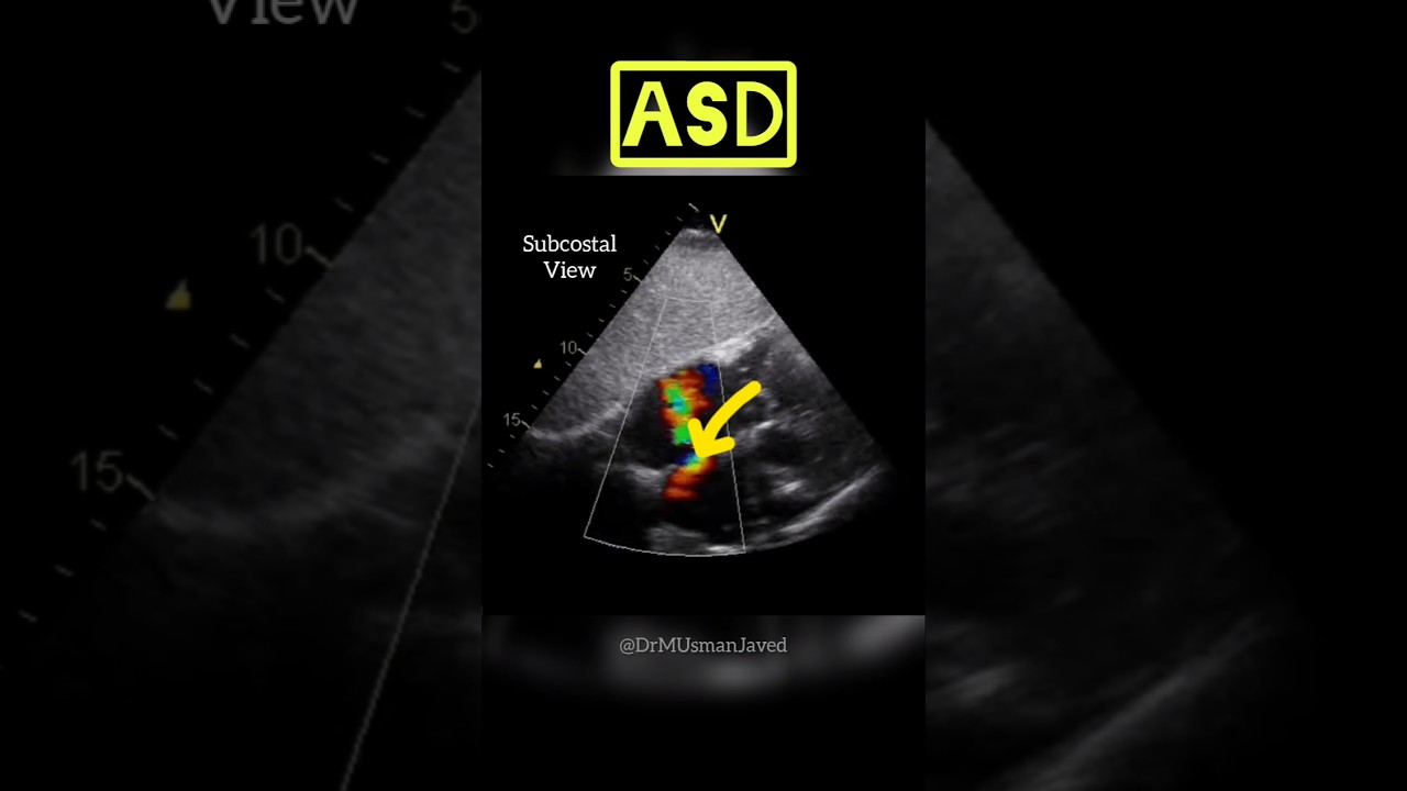 Atrial Septal Defect - ASD on Echocardiography #heart #heartdisease