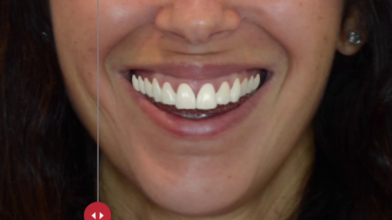 Digital Smile Design 7: Gummy Smile