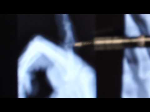 Middle Phalanx Fracture.MP4