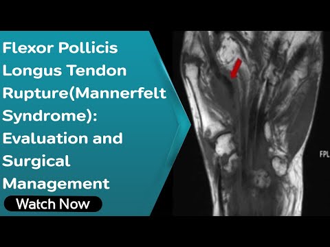 Flexor Pollicis Longus Tendon Rupture (Mannerfelt Syndrome): Evaluation ...