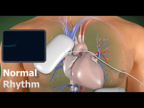 Learn how an AED works - 3D Animation