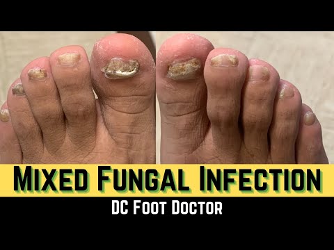 Mixed Fungal Infection