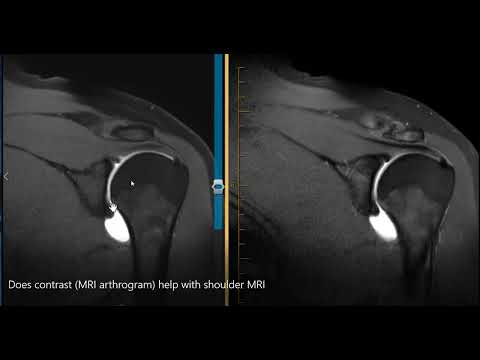 Does MRI arthrogram help see the labrum?