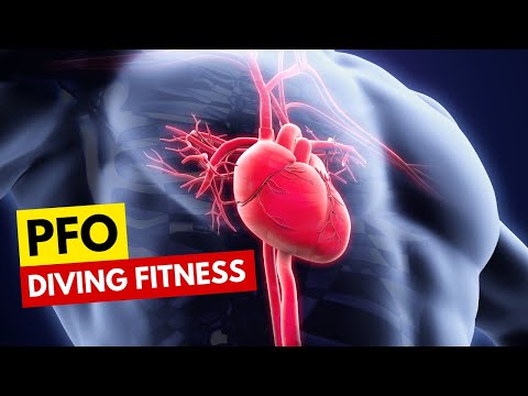 Patent Foramen Ovale and Dive Fitness