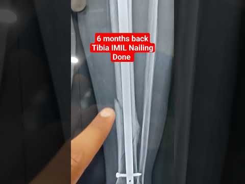 6 months back Tibia IMIL Nailing Done ..Dr Sai Chandra #tibiafracture #tibia