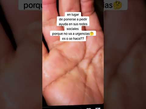 SE QUEMÓ LA MANO ÑIOSA