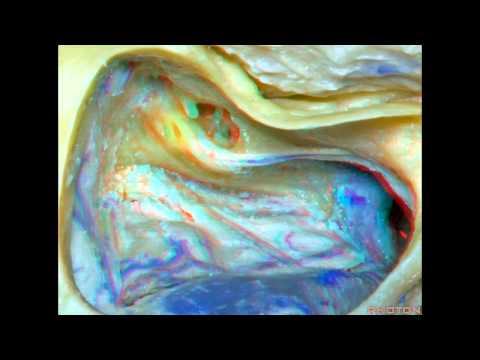 Menavigasi Tulang Temporal (3D) - Bagian 3 dari 3