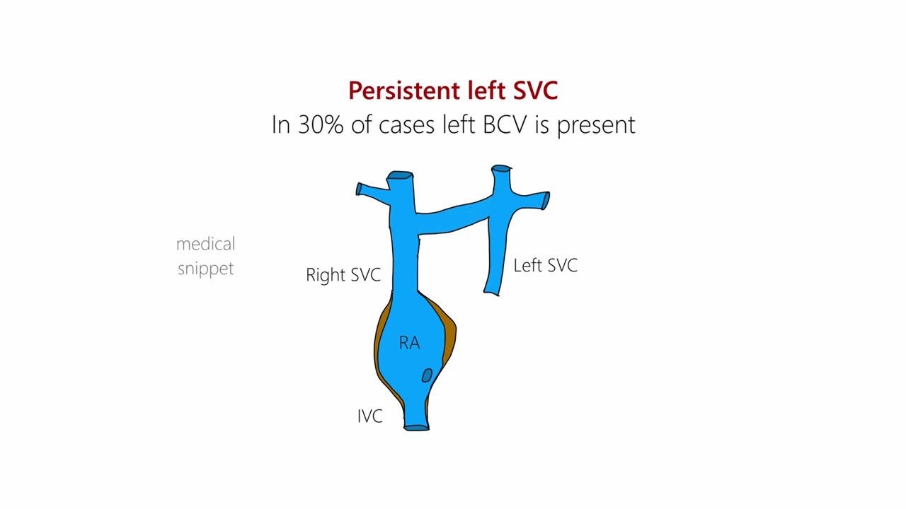 Persistent Left Superior Vena Cava (Left SVC) | Embryology and Clinical Anatomy