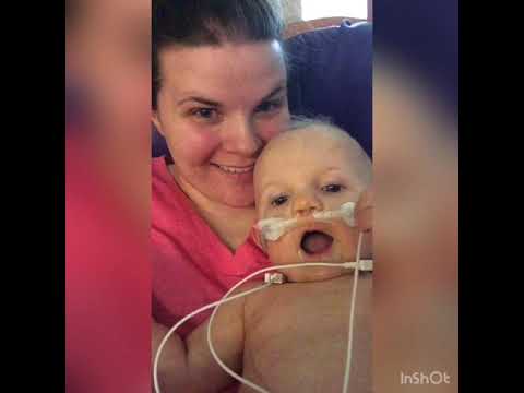 Adams-Oliver Syndrome, Pulmonary hypertension.