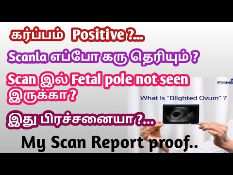 Anembryonic pregnancy in tamil | blighted ovum in tamil | early pregnancy at 6 week in tamil