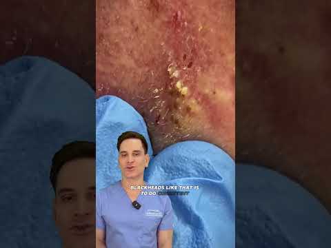 Doctor REACTS To CRAZY Blackhead Cluster!