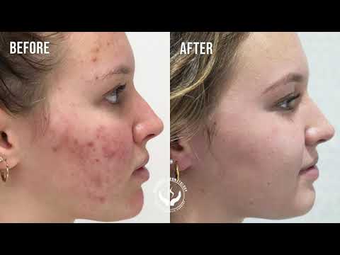 Acne Treatment
