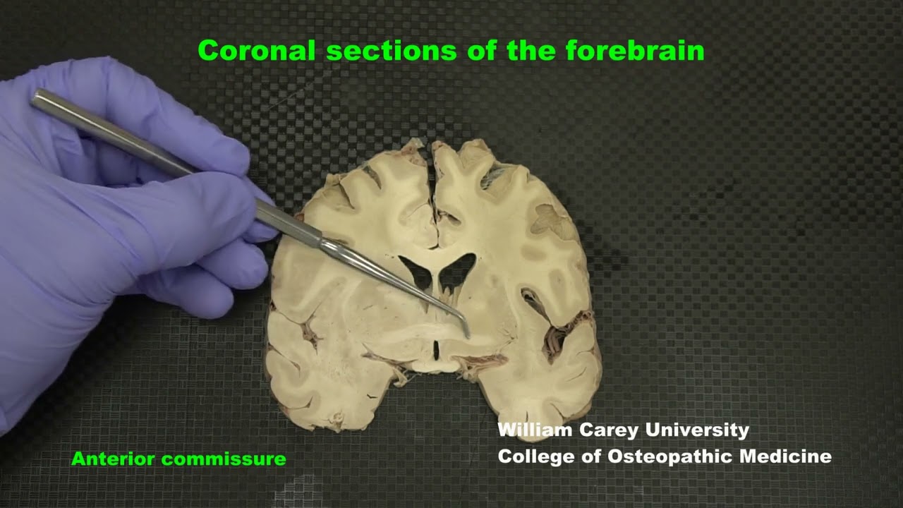 Human forebrain coronal levels. Septum, preoptic area, hypothalamus#neuroanatomy#brain #brainanatomy
