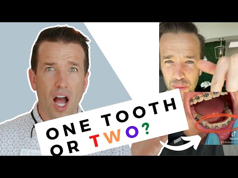 Orthodontist Explains What the heck happened to this tooth?! #shorts