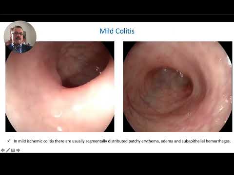 Ischemic Colitis