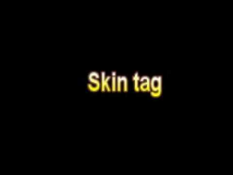 What Is The Definition Of Skin tag Medical School Terminology Dictionary