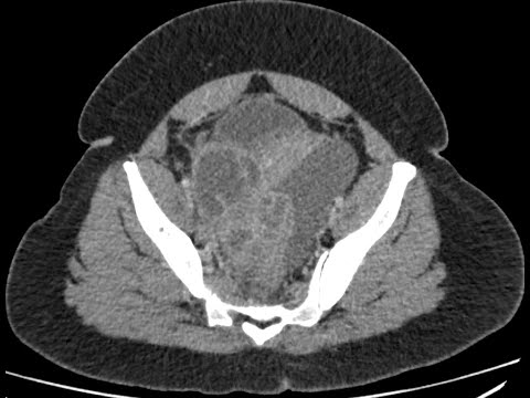 Tubo ovarian abscess - Inflammatory Pelvic Disease - IPD - CT findings
