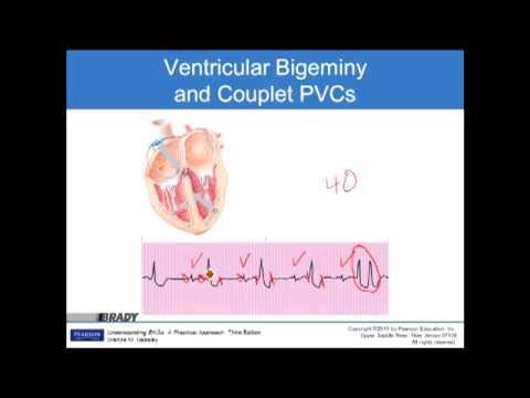 Basic EKG Chapter 10 Ventricular Rhythms