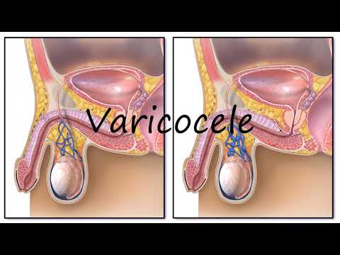 How to Pronounce Varicocele?