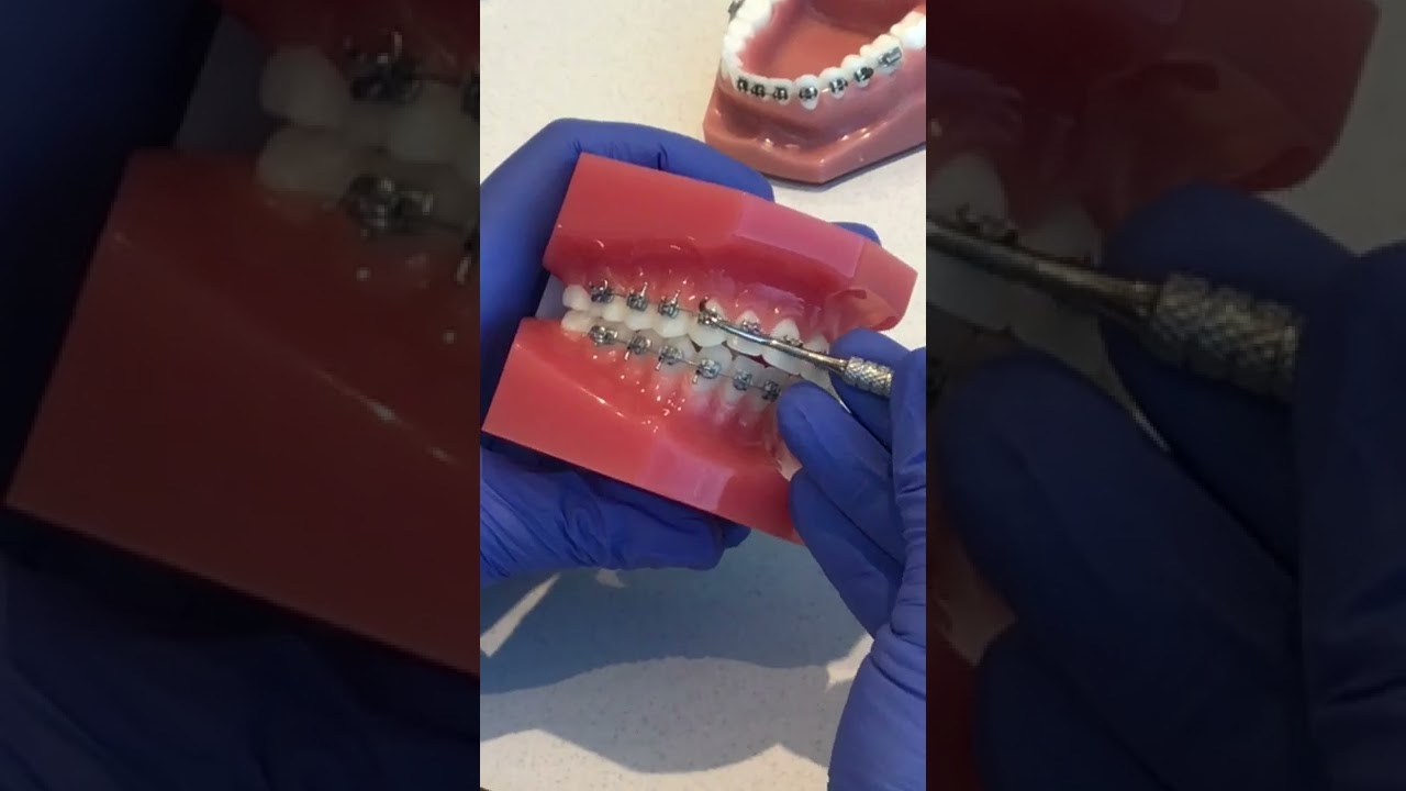 Class III Vertical Elastic