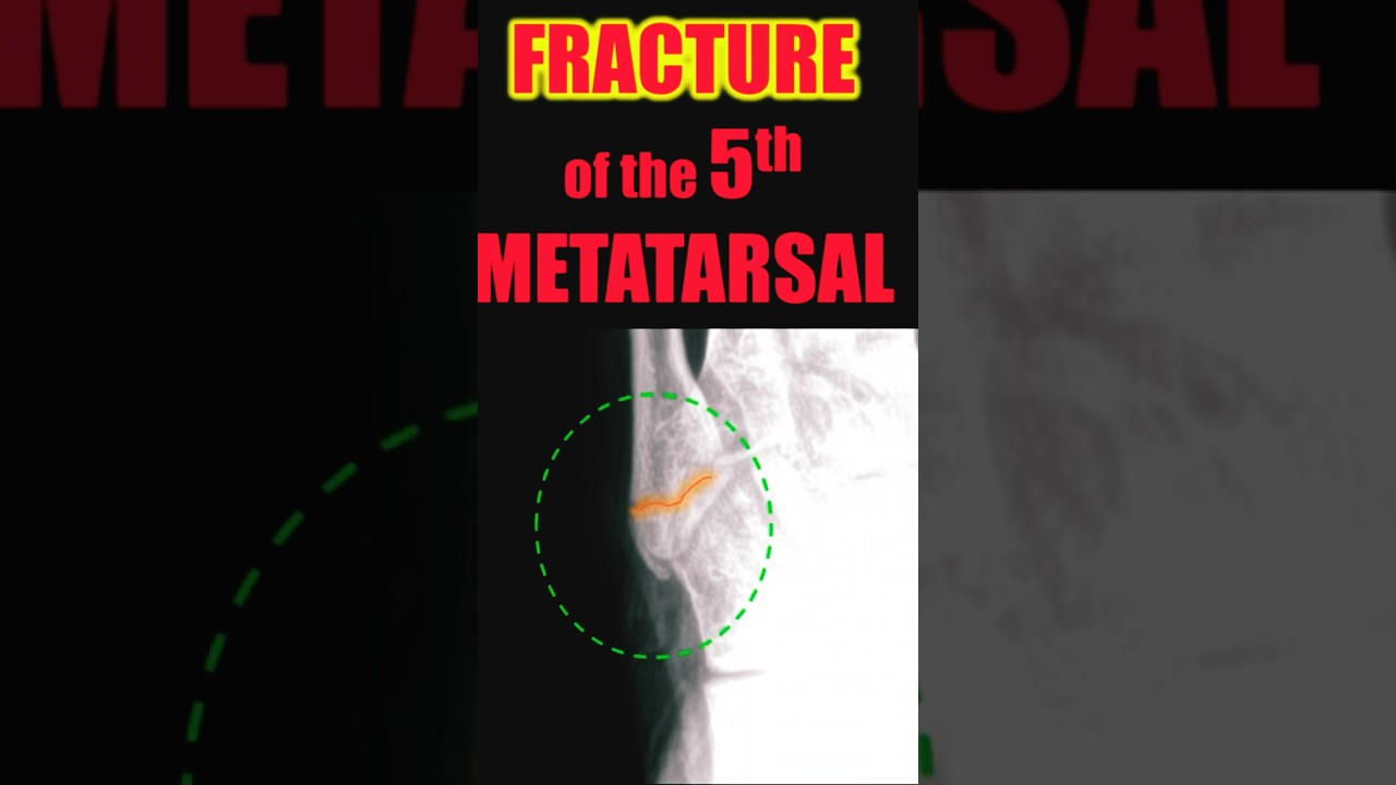 Fracture of the 5th Metatarsal #trauma #radiology #doctor