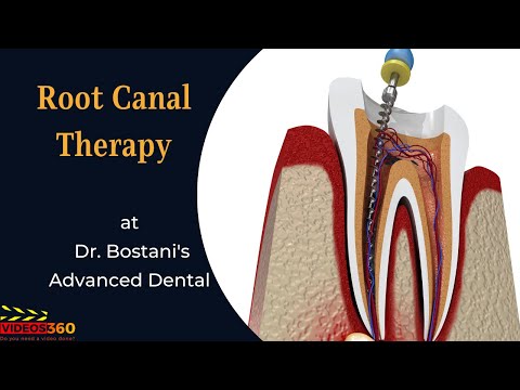 Root Canal Therapy at V360 Dr Bostani