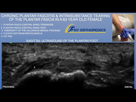 Ultrasound of Chronic Plantar Fasciitis & Intrasubstance Tearing in a 63 Year Old Female