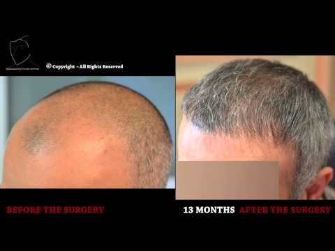 FUE 3090 Ufs MeDiKemos Hair Transplantation ENG