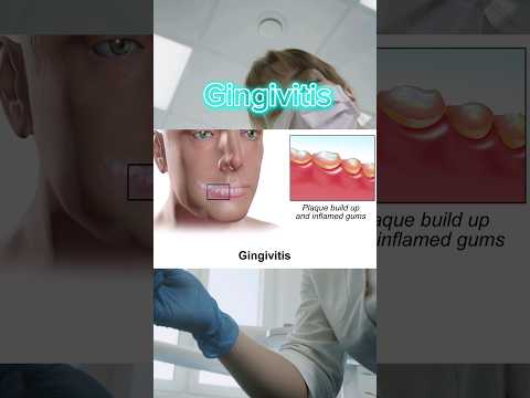 GINGIVITIS - MEDICAL DEFINITION | Medical Consecutive Interpreting