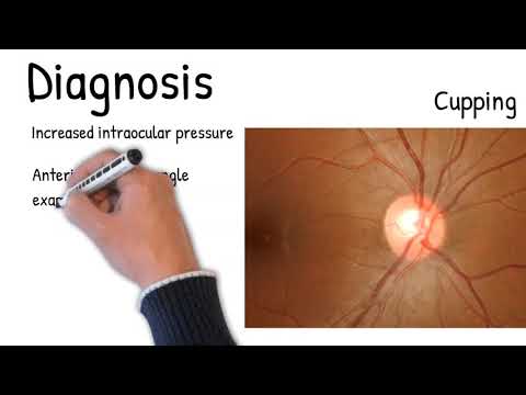Glaucoma - Explained easy. Mechanism, symptoms, treatment, prognosis