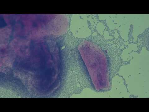 Gynaecology. Bacterial vaginosis.