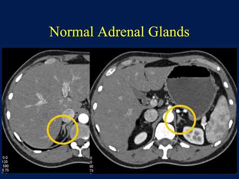 CT of the Adrenal Mass: A Challenging Diagnosis Becomes Even More Difficult - Part 1