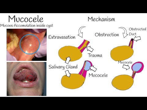 Oral Mucocele - The Most Common Mucosal lesion - Mucous Cyst: Symptoms, Causes & Treatment