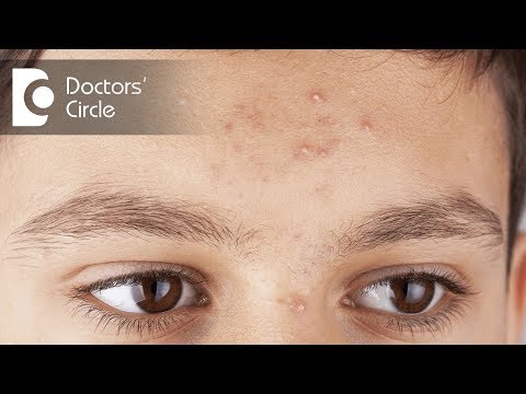Are there side effects with long term bactrim tablets taken for Scalp Acne? - Dr. Rasya Dixit