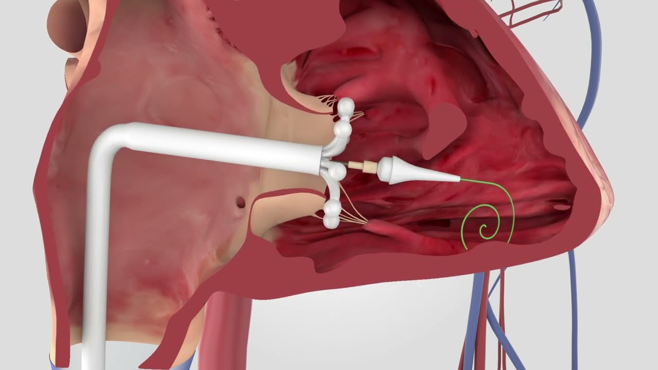 EVOQUE Tricuspid Valve Replacement System – transcatheter tricuspid valve replacement | Animation