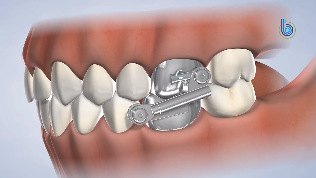 Rapid Palatal Expander Instructions in Omaha NE | Braces Omaha