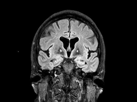 Hallovorden Spatz syndrome