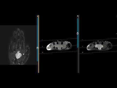 Palpable mass in palm of 33 year old